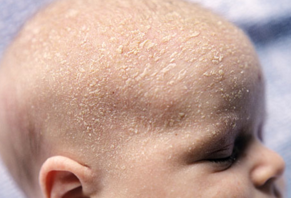hiperplasia sebacea dermatite seborreica - Pediatria Descomplicada