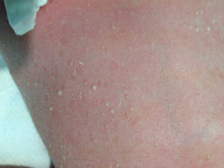 Melanose Pustulosa Neonatal Neonatal Dermatology | SpringerLink