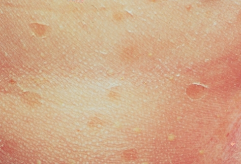 melanose pustulosa neonatal transitoria 3 - Pediatria Descomplicada