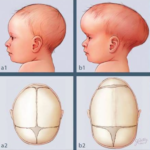 Quando a moleira fecha precocemente, o que fazer? - Pediatria Descomplicada